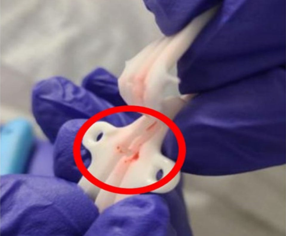 RECALL: Palindrome and Mahurkar Hemodialysis Catheters and How to Find